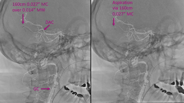 Posterior Cerebral Artery Inferior Calcarine Thrombectomy