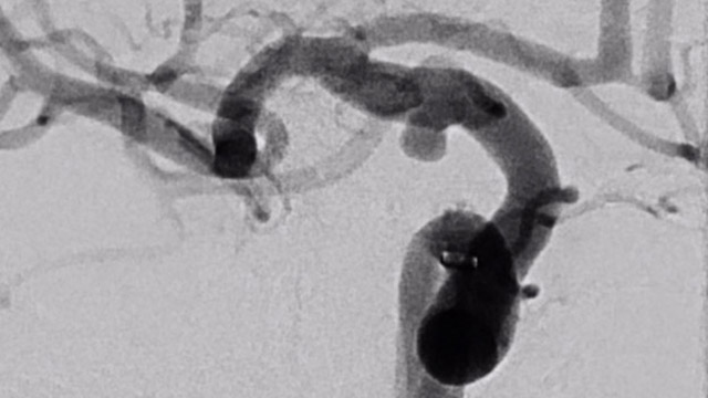 Experience a step-by-step Radial access DSA