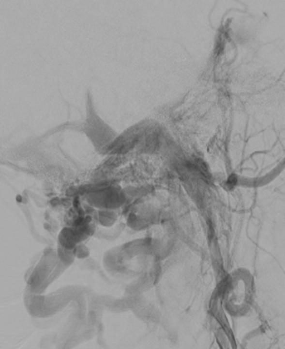 Therapy of a DAVF Cognard 2a: Transvenous embolization of a sigmoid ...