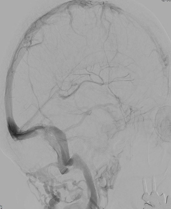 Therapy of a DAVF Cognard 2a: Transvenous embolization of a sigmoid ...