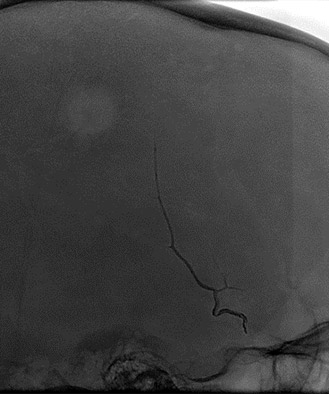 MMA embolization of a 79-year-old patient