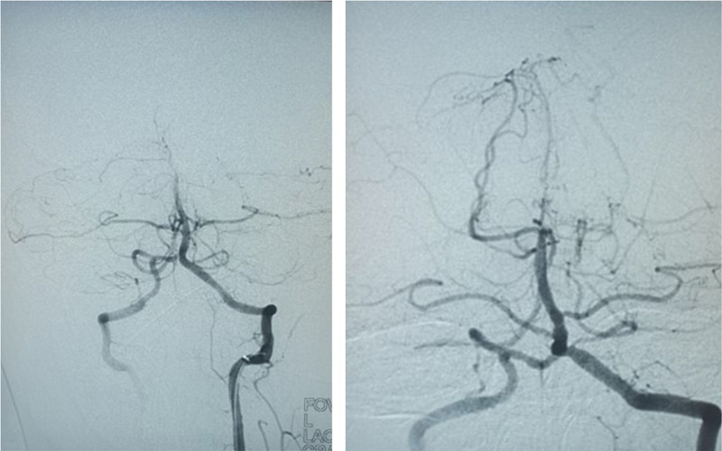A friend in need is a friend indeed – Ischemic stroke case where SOFIA ...