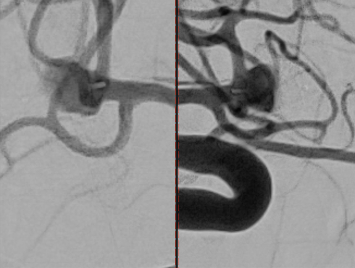 Ruptured aneurysm treated by web