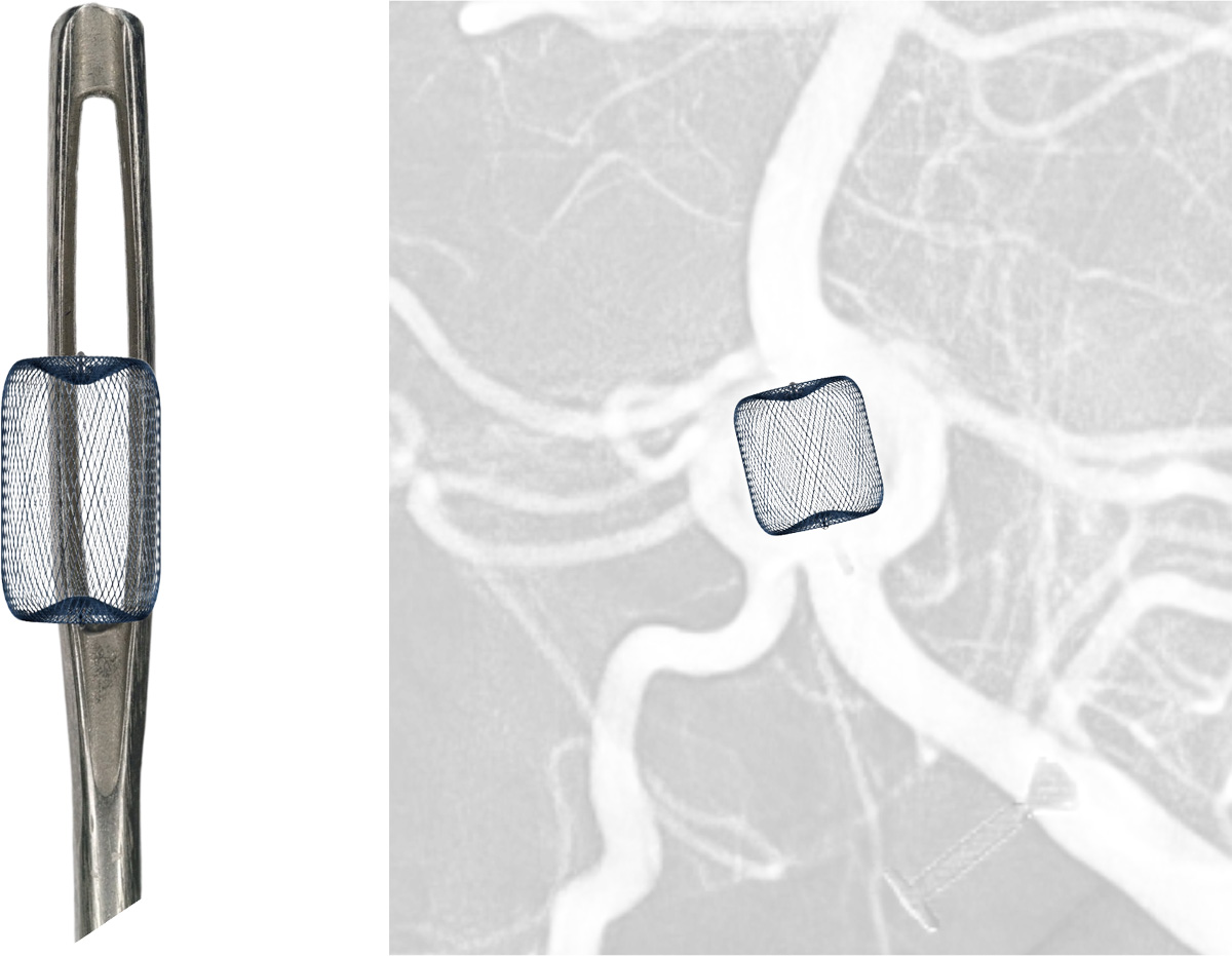 Threading the Needle: Intrasaccular WEB Device for the treatment of a ...