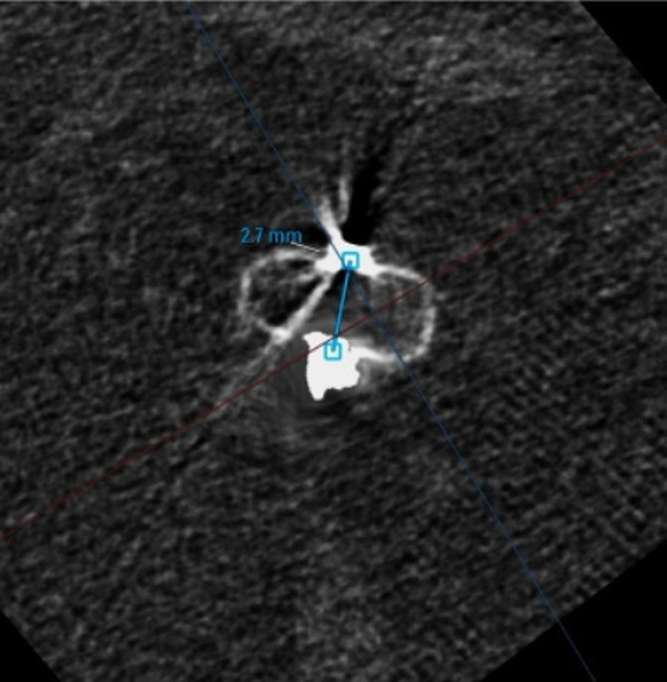 WEB Deployment in Off-Center Necks: The Added Value of Balloon Assistance