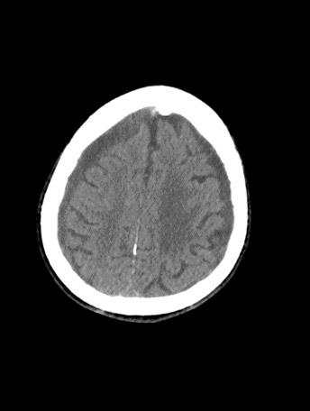 MMA embolization of a 96-year-old patient