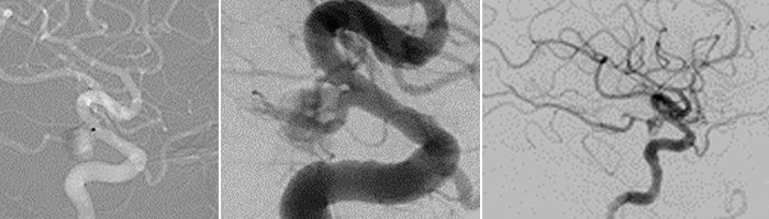 Rapidly growing PCOM-Aneurysm treated with the Contour Neurovascular ...