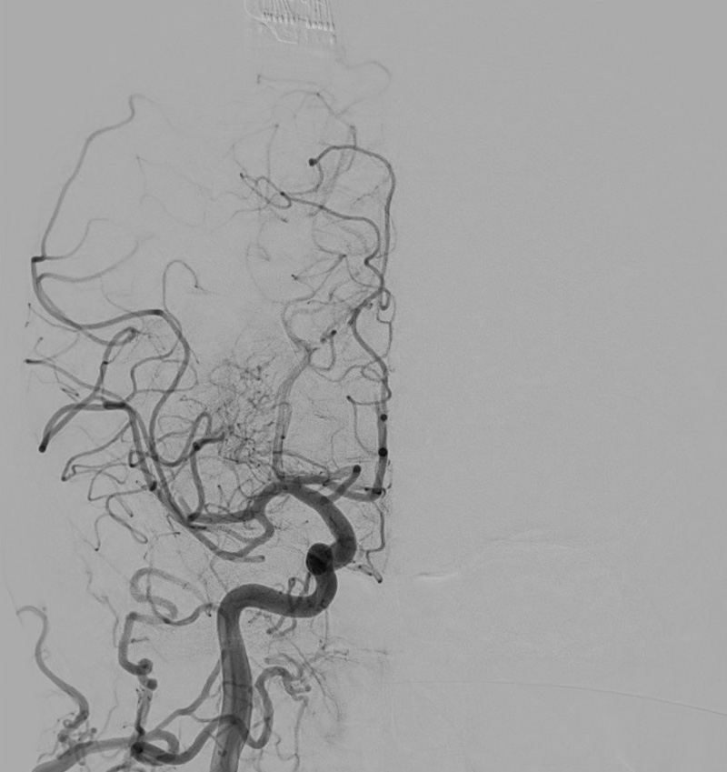 Double Solitaire™ for ACA and MCA stroke