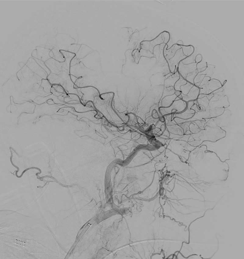 Double Solitaire™ for ACA and MCA stroke