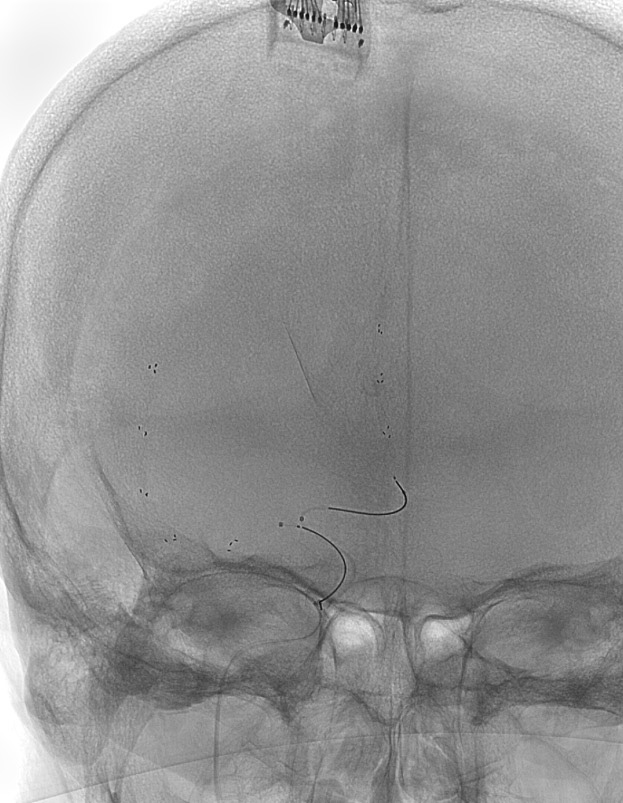 Double Solitaire™ for ACA and MCA stroke