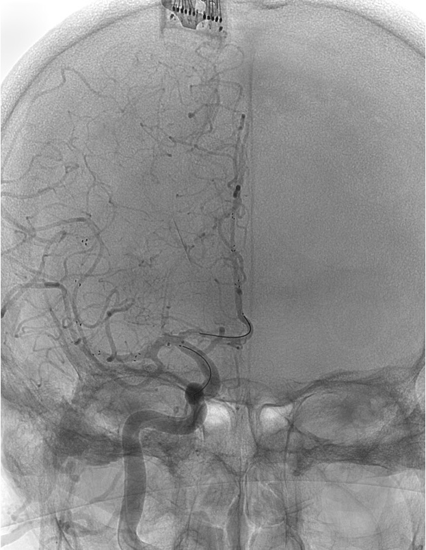 Double Solitaire™ for ACA and MCA stroke