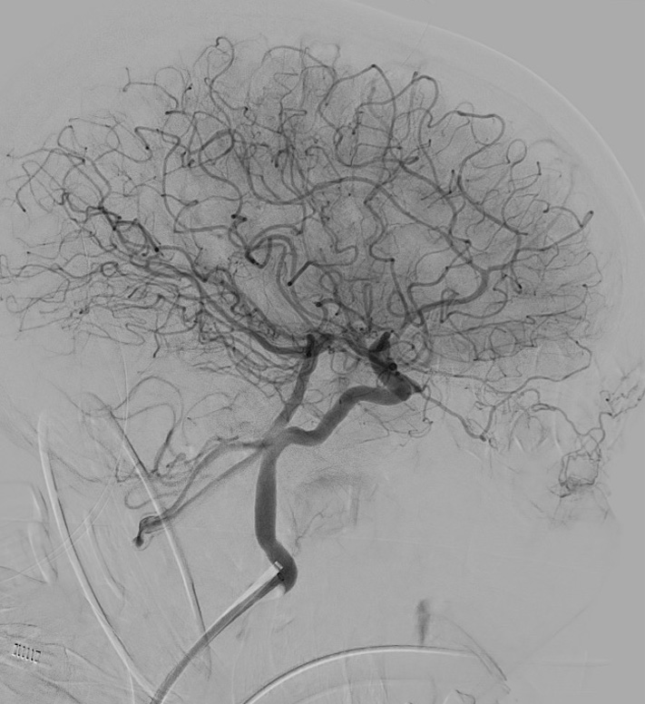 Double Solitaire™ for ACA and MCA stroke