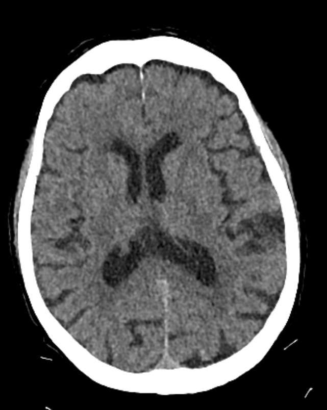 Double Solitaire™ for ACA and MCA stroke