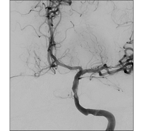 Double stenting technique thrombectomy and PTA treatment for ...