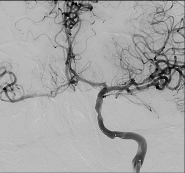 Double stenting technique thrombectomy and PTA treatment for ...