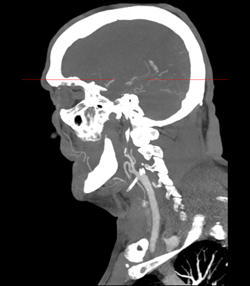 Double stenting technique thrombectomy and PTA treatment for ...