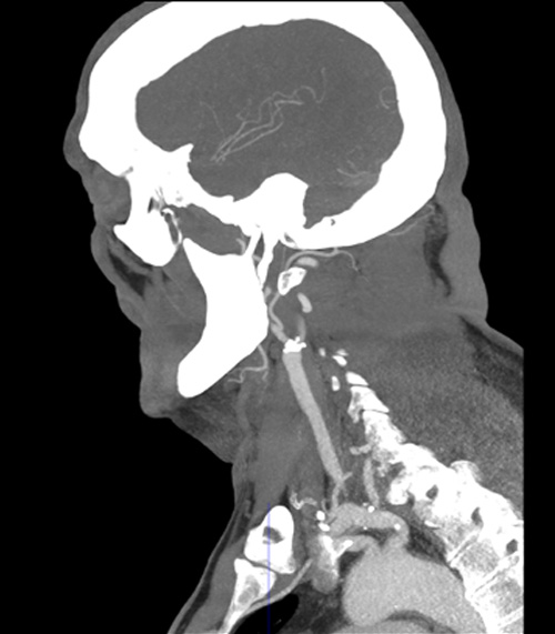Double stenting technique thrombectomy and PTA treatment for ...
