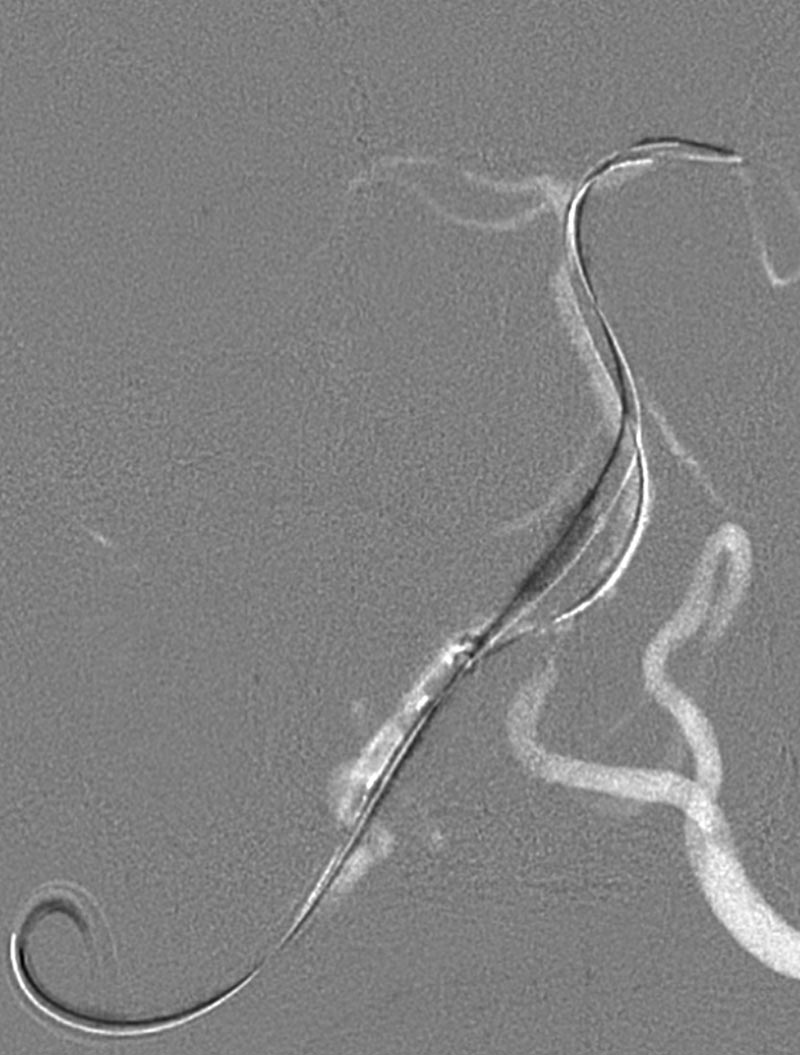 Basilar artery occlusion recanalized with thrombectomy, PTA and ...