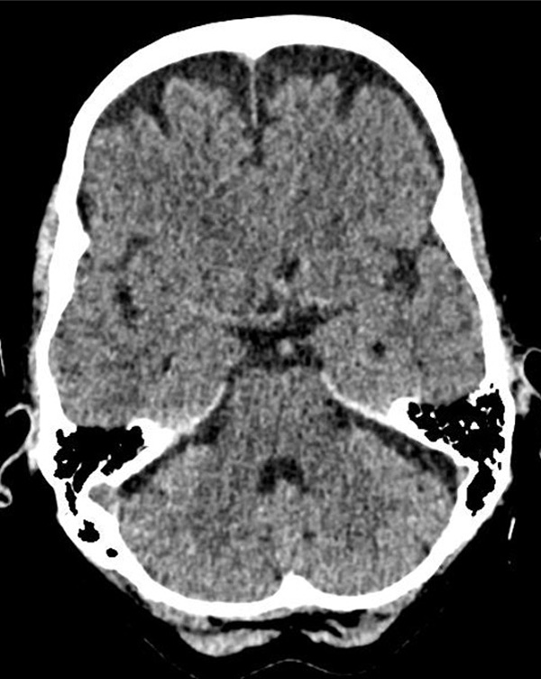 Implantation of an Artisse™ intrasaccular Device for an incidental Acom ...