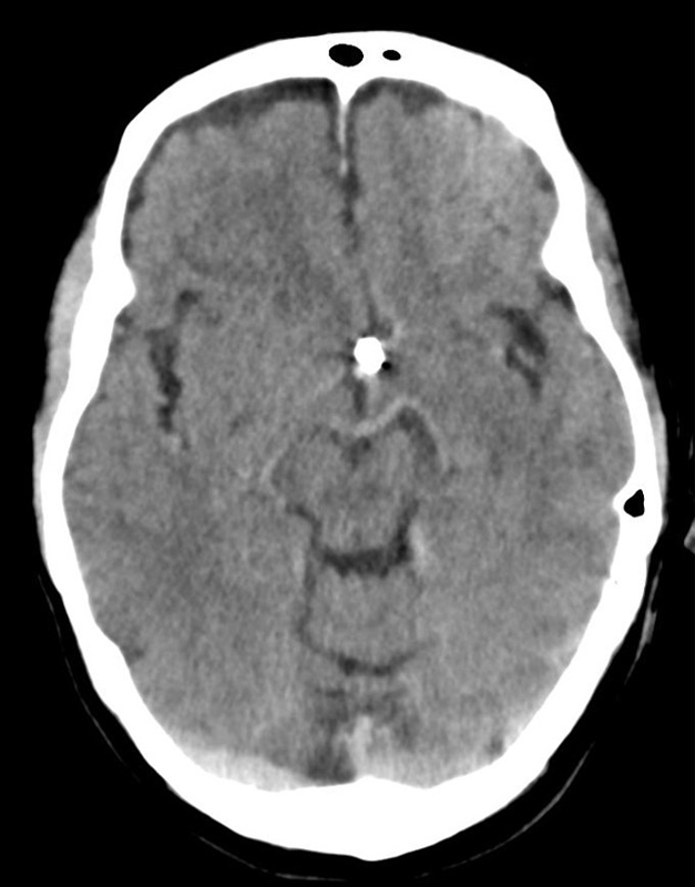 Implantation of an Artisse™ intrasaccular Device for an incidental Acom ...