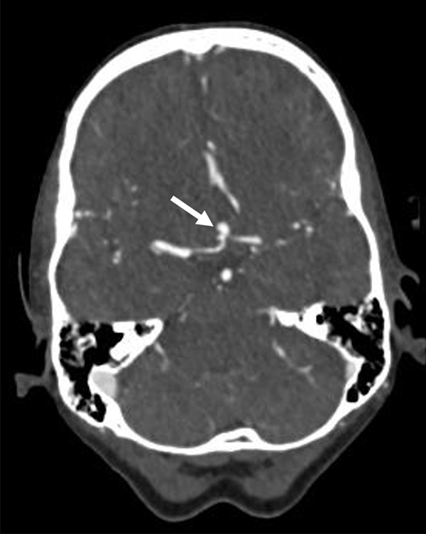 Implantation of an Artisse™ intrasaccular Device for an incidental Acom ...