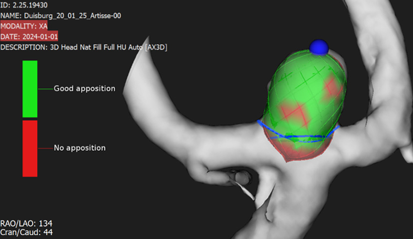 Implantation of an Artisse™ intrasaccular Device for an incidental Acom ...