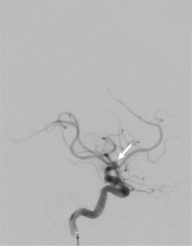 Implantation of an Artisse™ intrasaccular Device for an incidental Acom ...