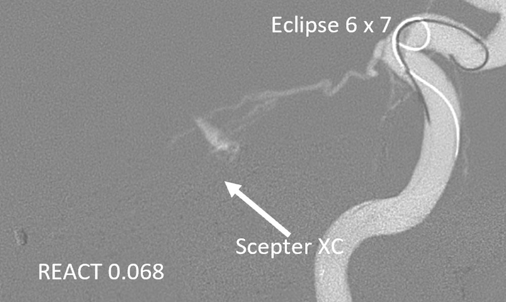 Retrograde transvenous embolization of a tentorial dural AV-Fistula