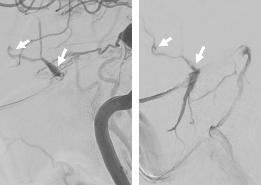 Retrograde transvenous embolization of a tentorial dural AV-Fistula
