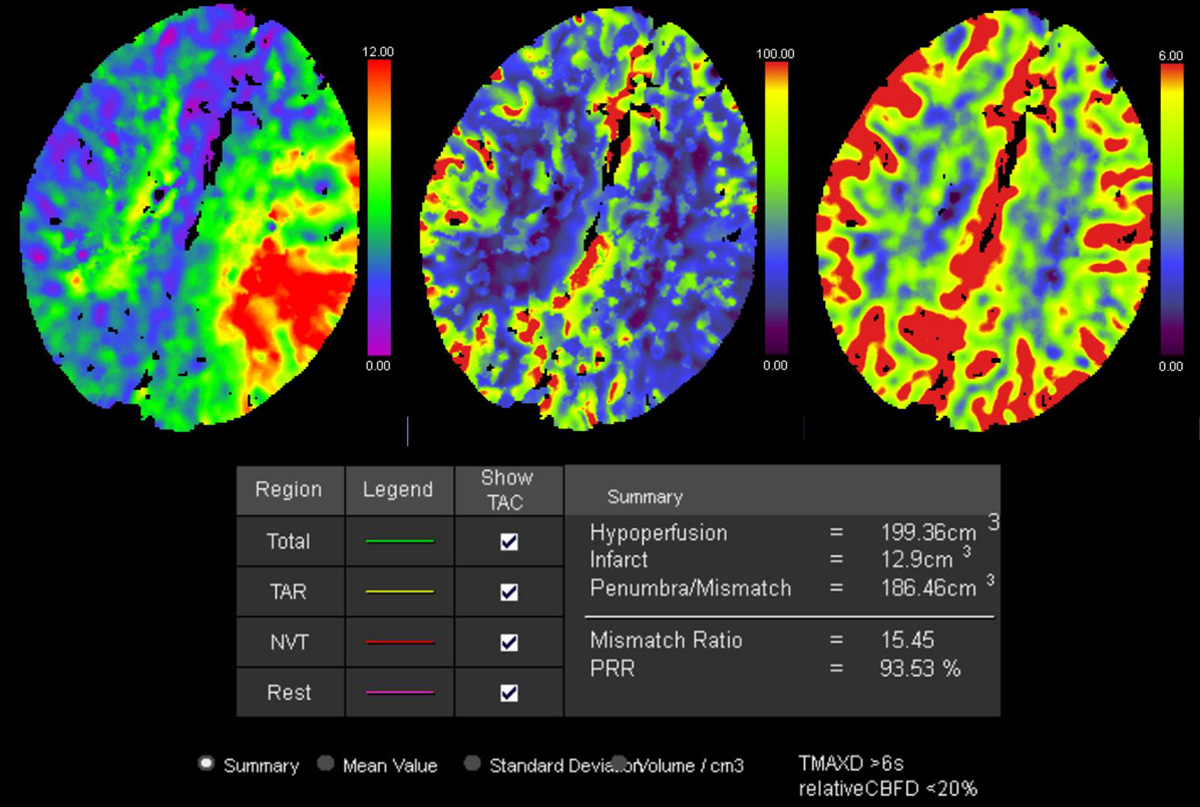 Extensive thrombus burden: Using the right material in the right ...
