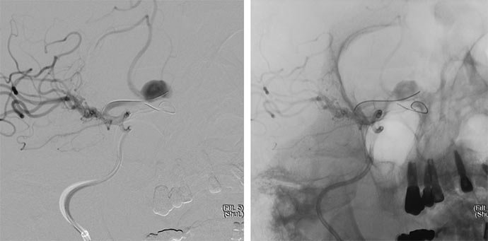 Large neck anterior communicating artery aneurysm: An unusual approach
