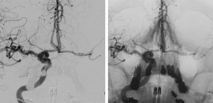 Large neck anterior communicating artery aneurysm: An unusual approach