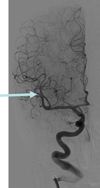 Distal occlusion thrombectomy with Solitaire™ X 3mm