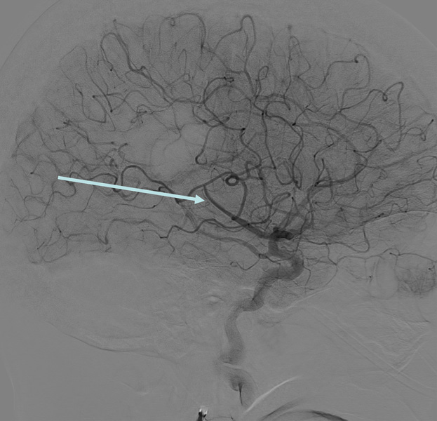 Distal occlusion thrombectomy with Solitaire™ X 3mm
