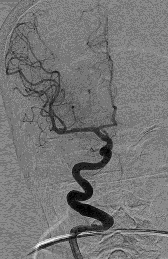 Distal occlusion thrombectomy with Solitaire™ X 3mm