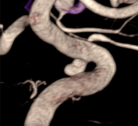 Complex anterior communicating artery (ACoA) aneurysm treatment with ...