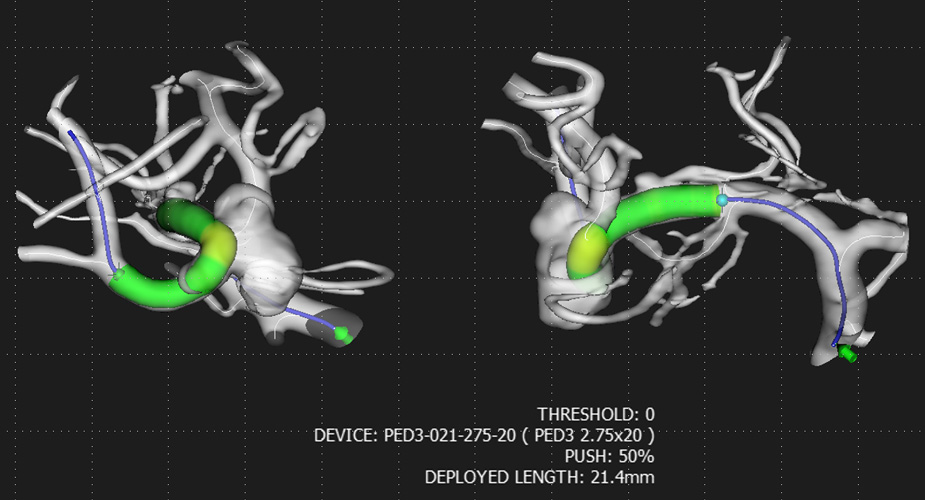 Complex right middle cerebral media artery (MCA) aneurysm treatment ...