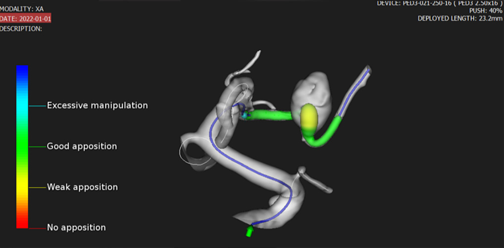Complex anterior communicating artery (ACoA) aneurysm treatment with ...