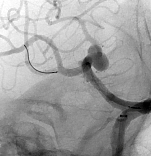 Complex right middle cerebral media artery (MCA) aneurysm treatment ...