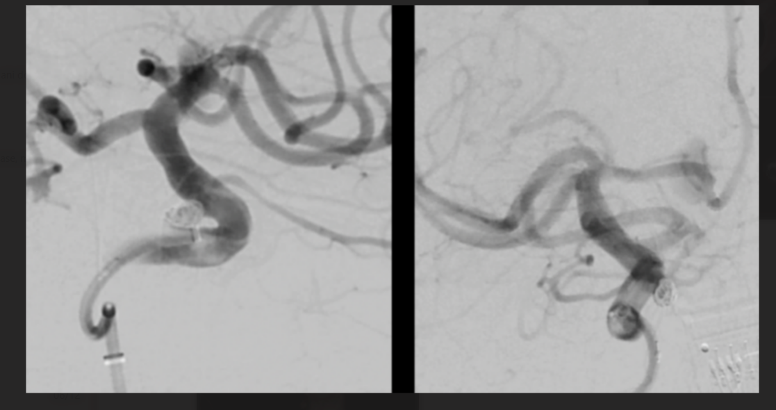 Complex anterior communicating artery (ACoA) aneurysm treatment with ...