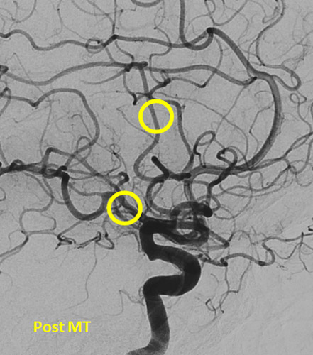 Solitaire 3x20 and 6x40 in simultaneous 2 branch occlusions with TICI ...