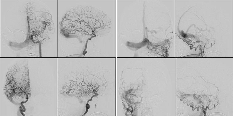 Multiple dural arteriovenous fistulas
