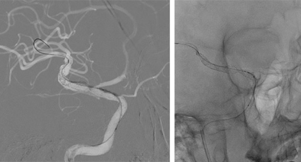Pediatric ICA aneurysm