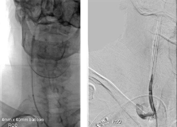 Recanalizing an acutely occluded, symptomatic, previously stented ...