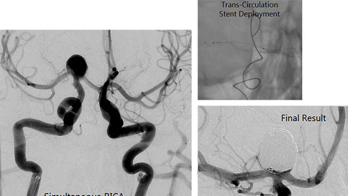 Retrieval of herniated coil during stent-assisted coiling