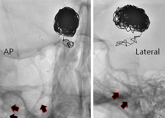Retrieval of herniated coil during stent-assisted coiling