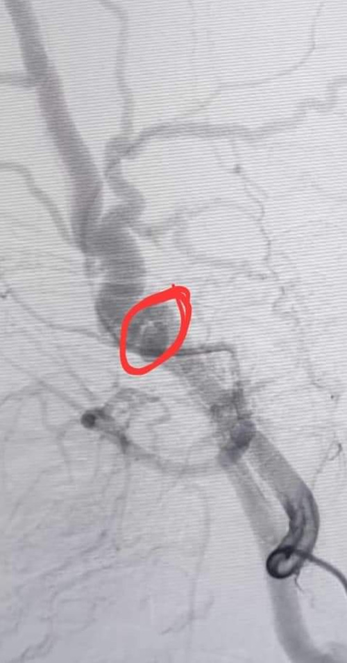 Endovascular treatment of the post-traumatic superficial temporal ...