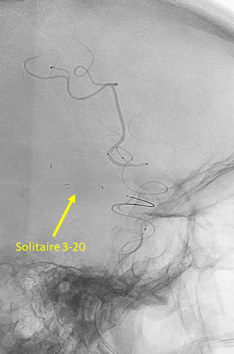Solitaire 3x20 and 6x40 in simultaneous 2 branch occlusions with TICI ...
