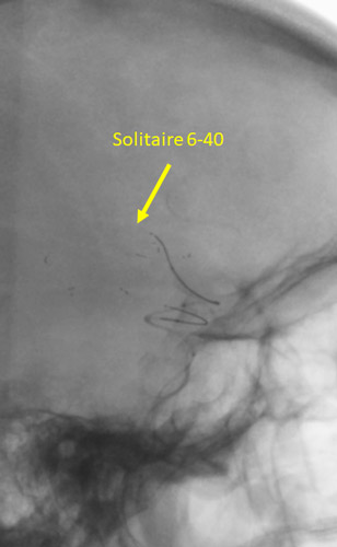 Solitaire 3x20 and 6x40 in simultaneous 2 branch occlusions with TICI ...