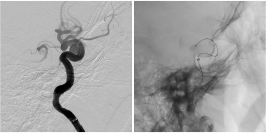 "Twisted" flow diverter resolved by "balloon-assisted technique"